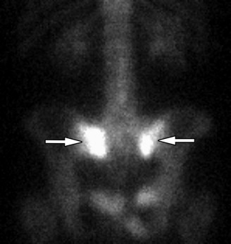 Schmorl’s Node | Radiology Key