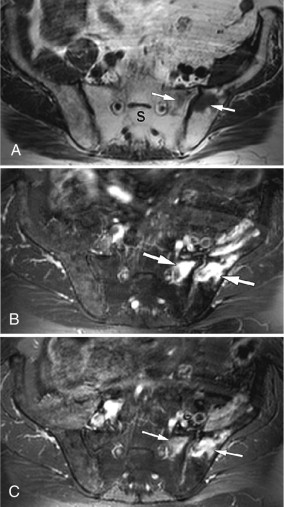 Sacroiliitis | Radiology Key