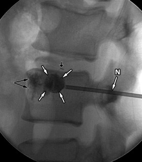 Schmorl’s Node | Radiology Key