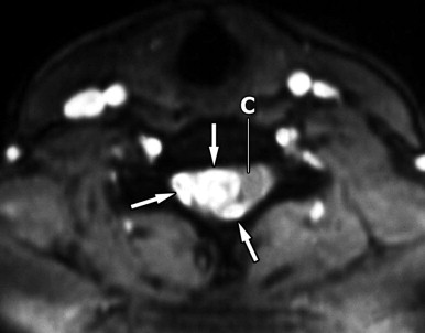 Spinal Cord Cavernous Angioma | Radiology Key
