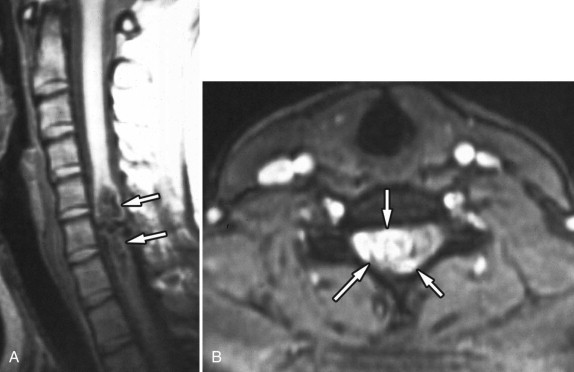 Spinal Cord Metastasis | Radiology Key