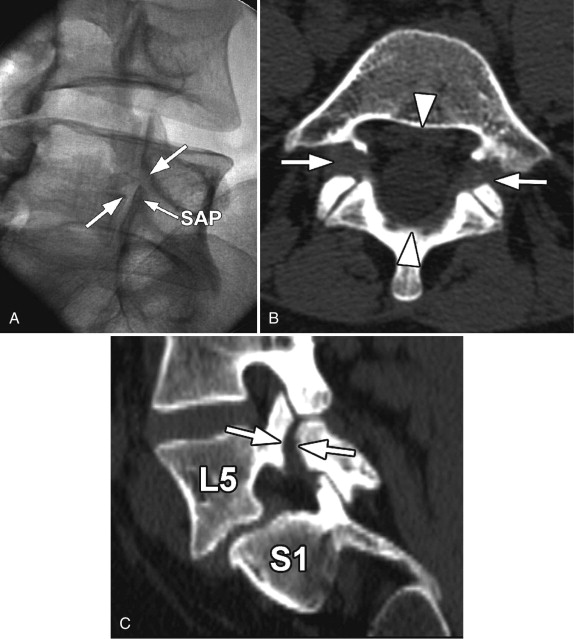 Vertebral Osteophytosis (Spondylosis Deformans) | Radiology Key