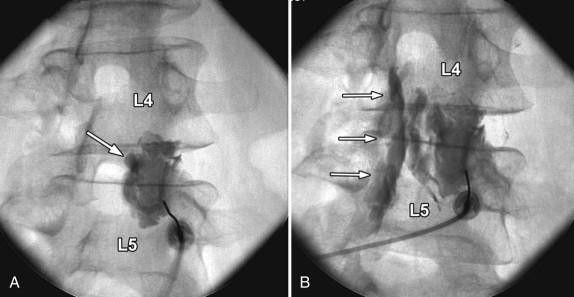 Synovial Cyst | Radiology Key