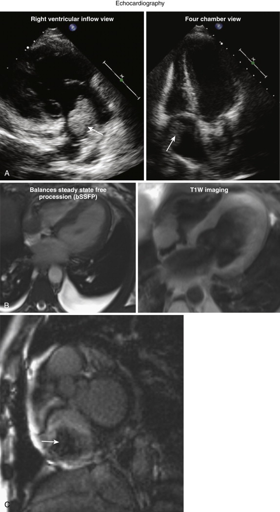 When to Choose What Test (Cardiac) | Radiology Key