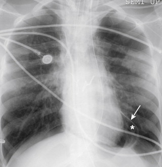 Cardiovascular Anatomy and Pathology on Radiography | Radiology Key