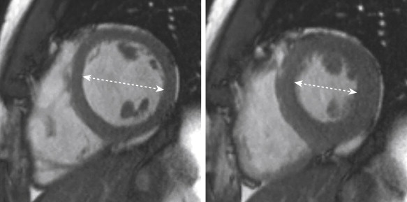 Cardiac Anatomy on Magnetic Resonance Imaging | Radiology Key