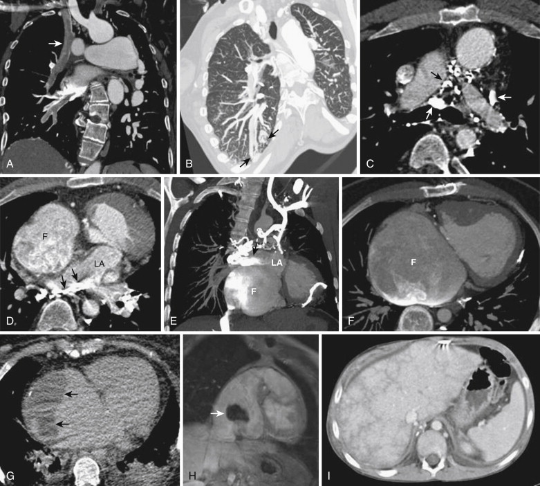 Imaging for Congenital Cardiovascular Disease | Radiology Key