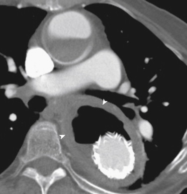 Imaging the Postoperative Thoracic Aorta | Radiology Key