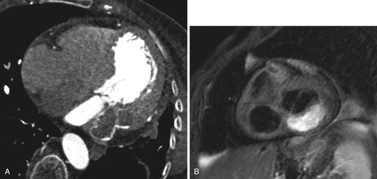Cardiac Masses | Radiology Key