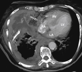 Pericardial Disease | Radiology Key
