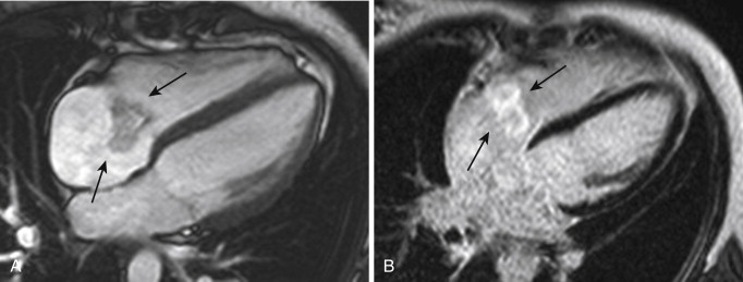 Valves: Magnetic Resonance Imaging | Radiology Key