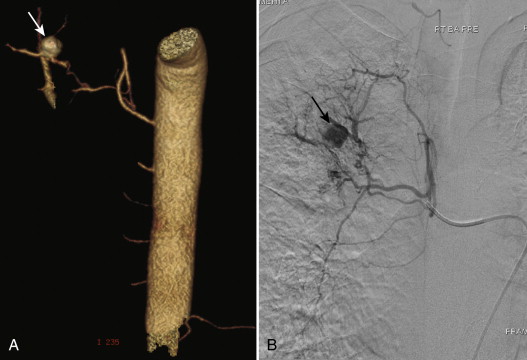 Bronchial Arteries | Radiology Key