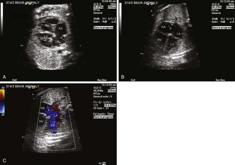 Atrial Septal Defects | Radiology Key