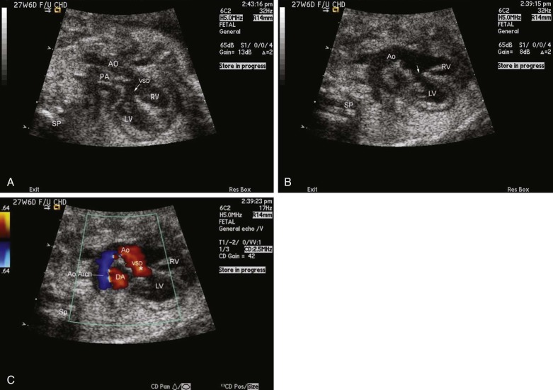 Double-Outlet Right Ventricle | Radiology Key