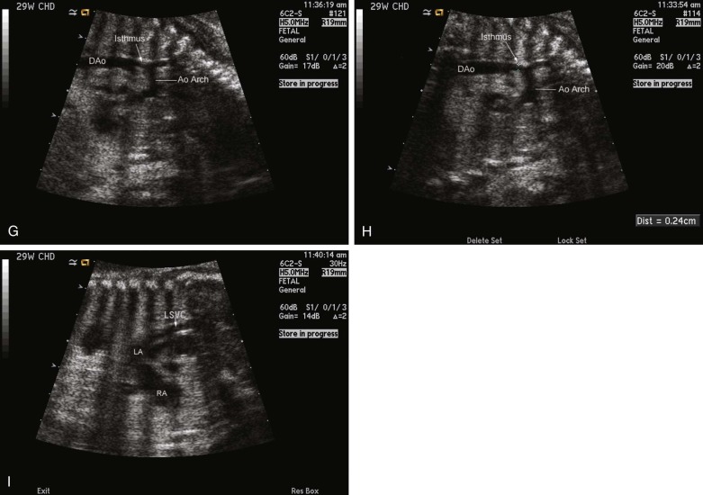Coarctation of the Aorta | Radiology Key