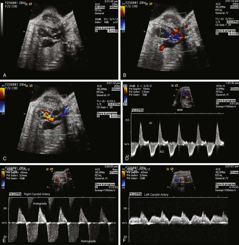 Congenital Absence of Aortic Valve Leaflets | Radiology Key