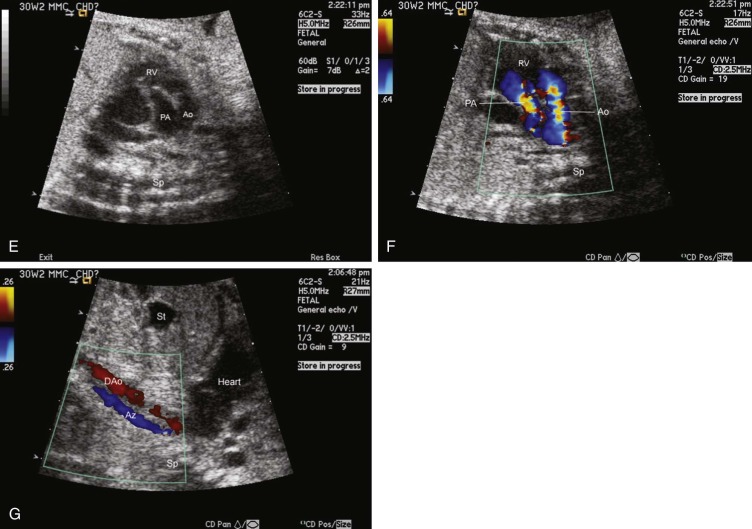 Heterotaxy Syndrome and Complex Single Ventricle | Radiology Key