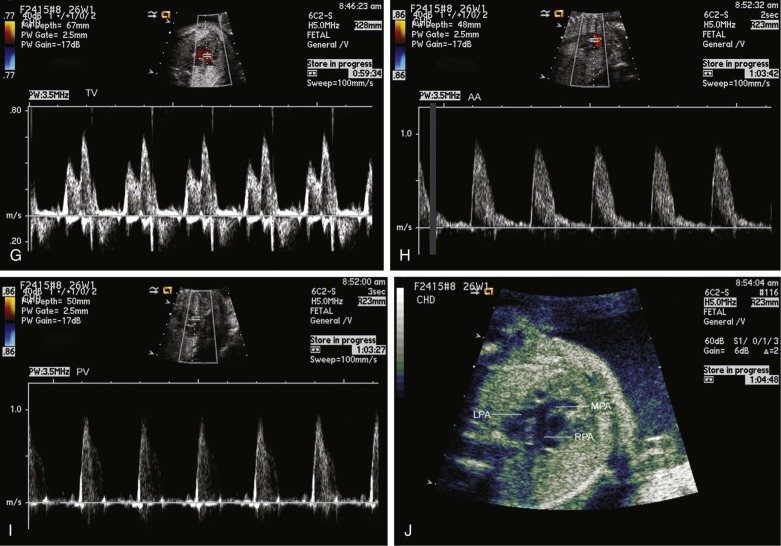 Double-Inlet Left Ventricle | Radiology Key