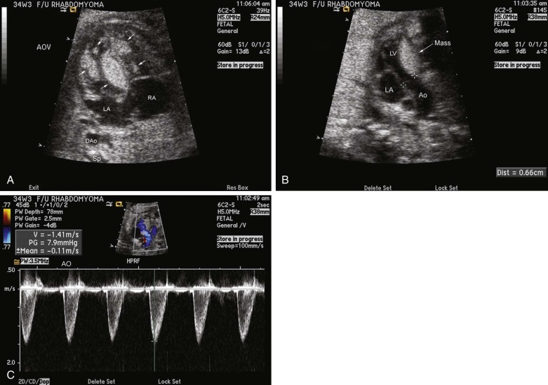 Cardiac Masses and Tumors | Radiology Key