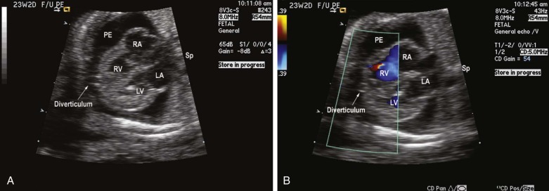 Diverticulum or Aneurysm of the Ventricle | Radiology Key