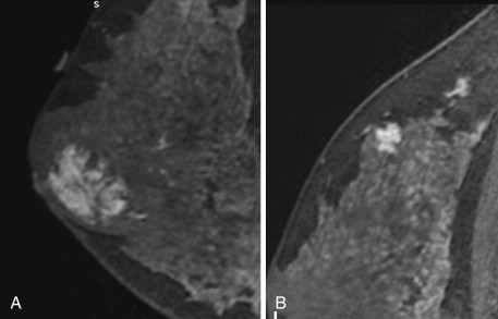 MRI Features of Ductal Carcinoma in Situ | Radiology Key