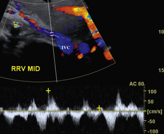 Anatomy and Normal Doppler Signatures of Abdominal Vessels | Radiology Key