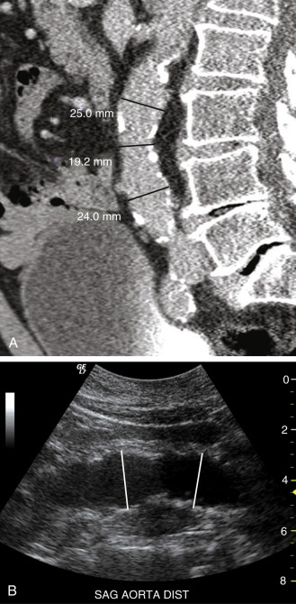 Ultrasound Assessment of Lower Extremity Arteries | Radiology Key
