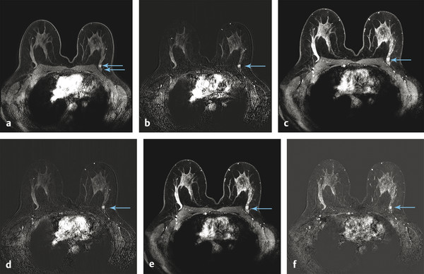 Abbreviated Breast Magnetic Resonance Imaging Protocols and Clinical ...