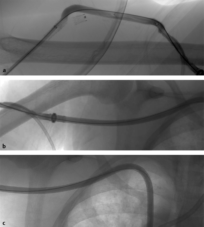 Dialysis Access and Interventions | Radiology Key