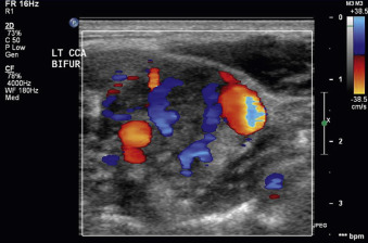 Neck Masses | Radiology Key