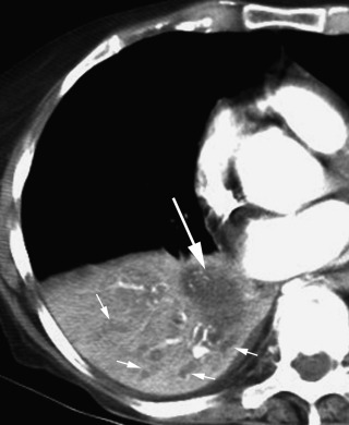 The Pulmonary Hila | Radiology Key