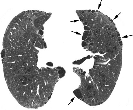 Lung Disease | Radiology Key