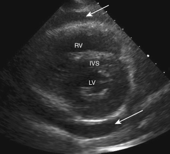 Ultrasound Artifacts | Radiology Key