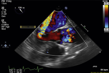 Focused Transesophageal Echocardiography | Radiology Key