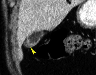 Biliary Tree and Gallbladder | Radiology Key