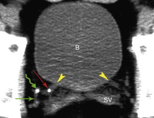 Kidneys and Ureters | Radiology Key