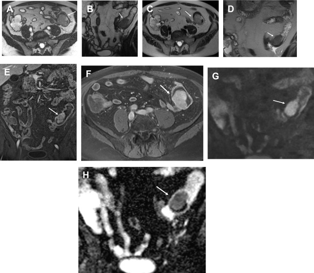 Magnetic Resonance of Small Bowel Tumors | Radiology Key