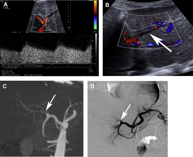 Imaging of Acute Hepatobiliary Dysfunction | Radiology Key
