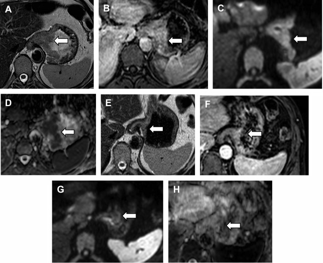 Esophagus and Stomach | Radiology Key