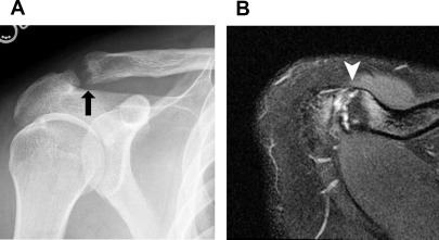 Radiographic/MR Imaging Correlation of the Shoulder | Radiology Key