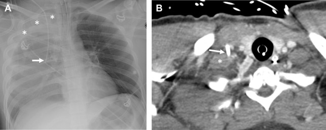 Imaging Approach to Misplaced Central Venous Catheters | Radiology Key