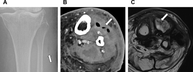 Radiographic/MR Imaging Correlation of Soft Tissues | Radiology Key