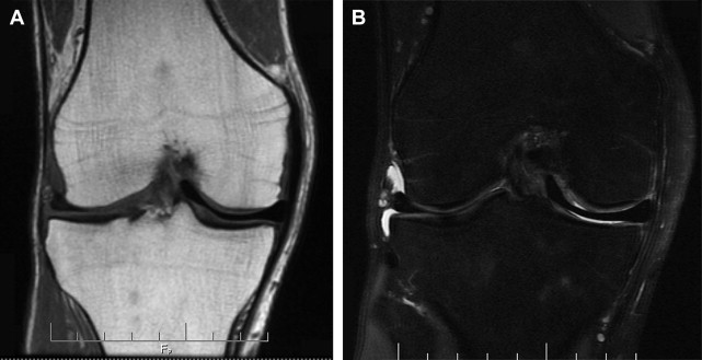 Magnetic Resonance Imaging of the Postoperative Meniscus | Radiology Key