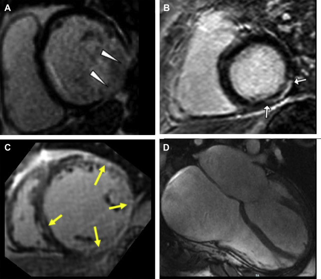 Comprehensive Assessment of Cardiac Involvement in Muscular Dystrophies ...