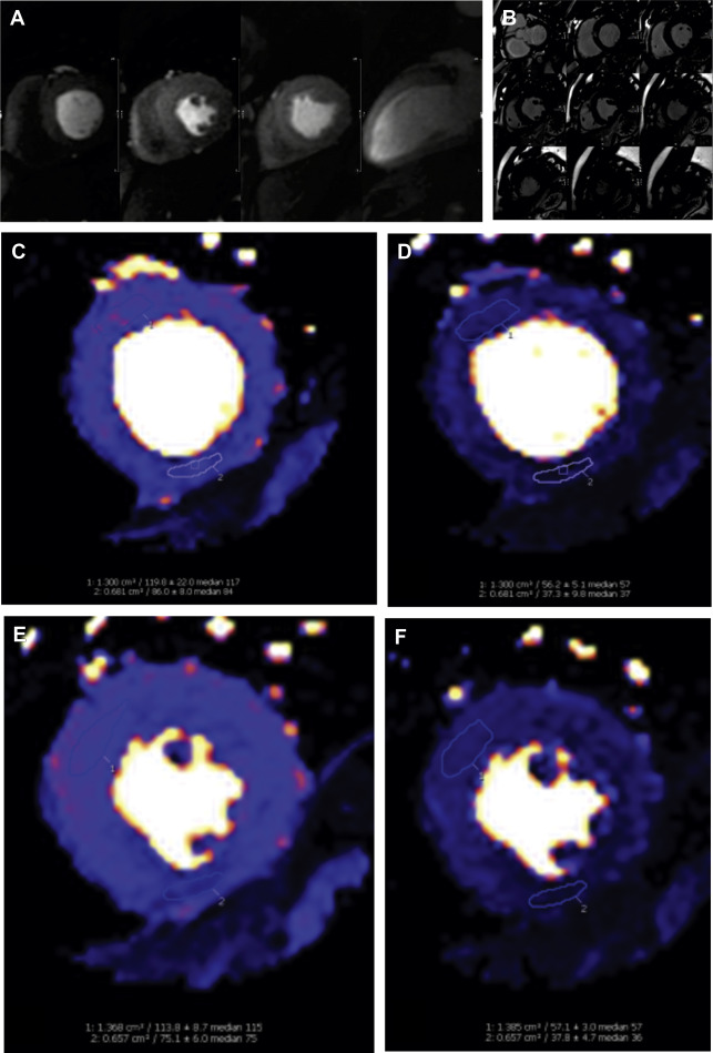 Automated Quantitative Stress Perfusion in a Clinical Routine ...