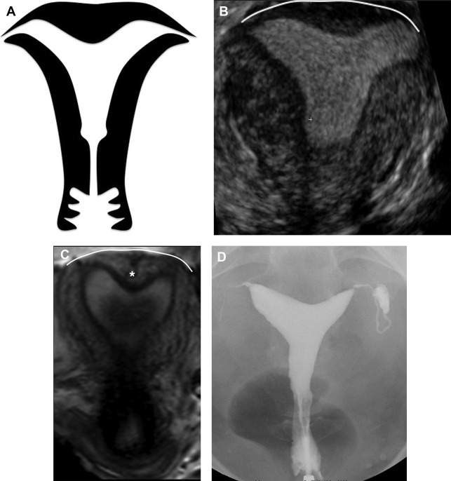Imaging of Infertility, Part 2 | Radiology Key