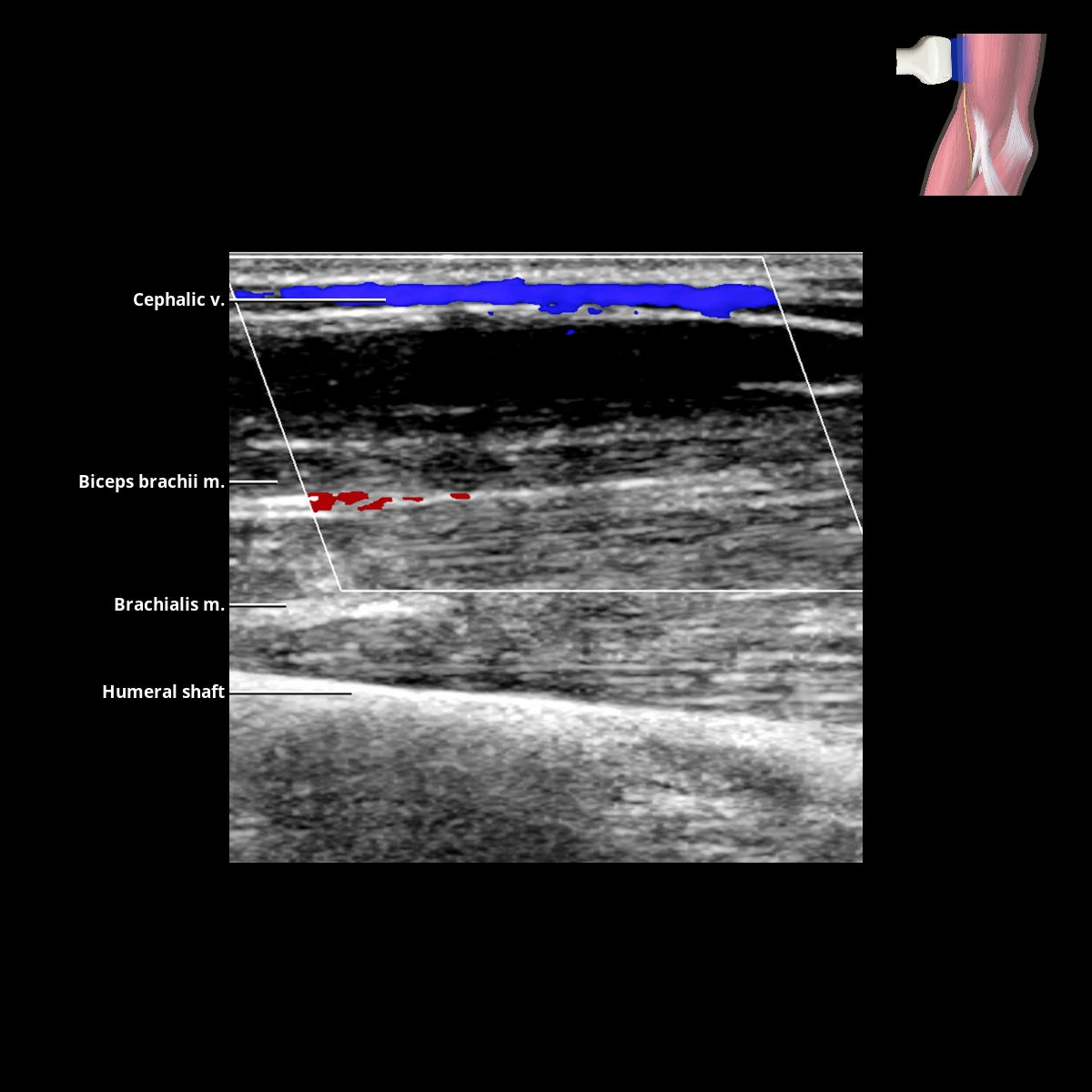 Arm Vessels | Radiology Key