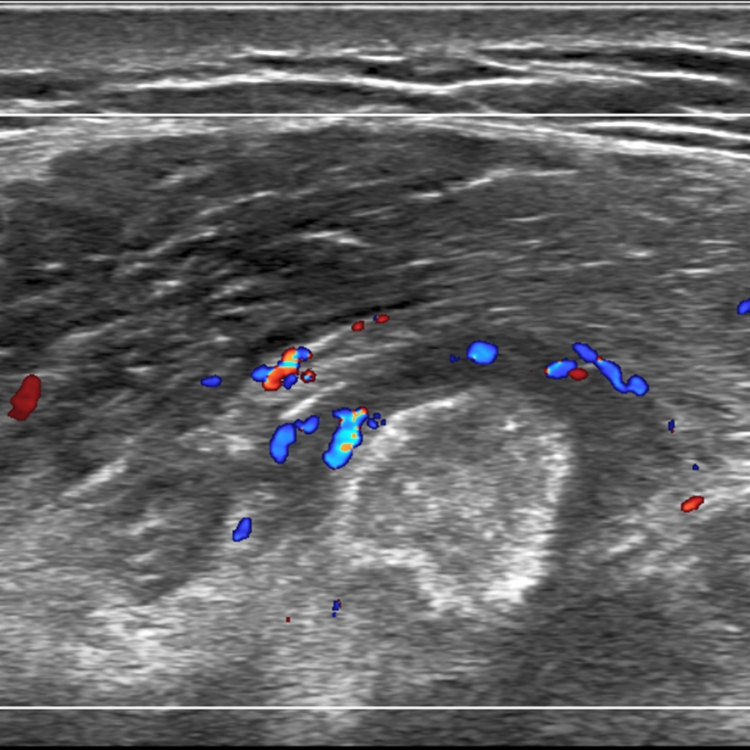 Rotator Cuff/Biceps Tendinosis | Radiology Key