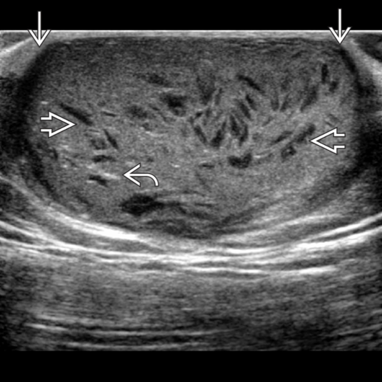 Epidermoid Cyst Icd 10 Epidermoid Cyst Icd 10