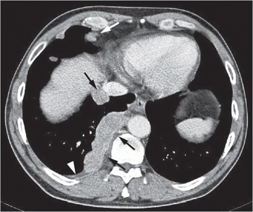 Pleural Diseases | Radiology Key